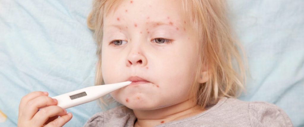 Chickenpox / Varicella – Health Insure Savvy