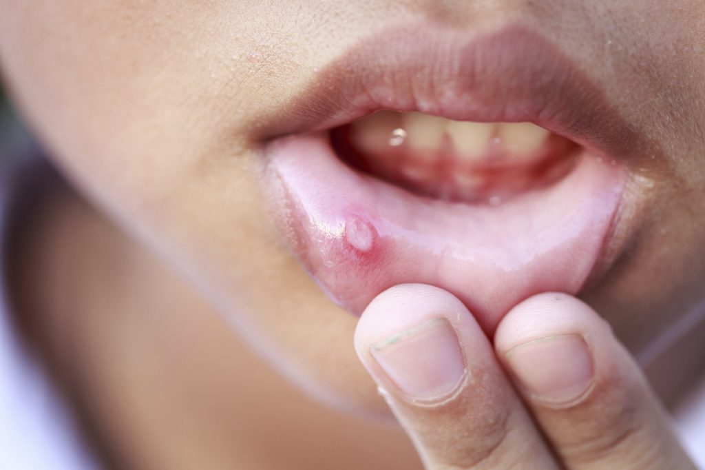Oral Ulcers – Health Insure Savvy